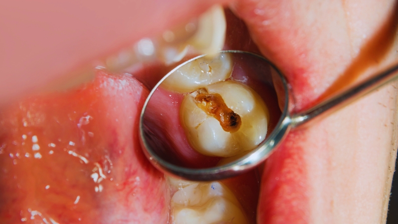 Symptoms And Treatment Of Tooth Infection | Dimension Dental