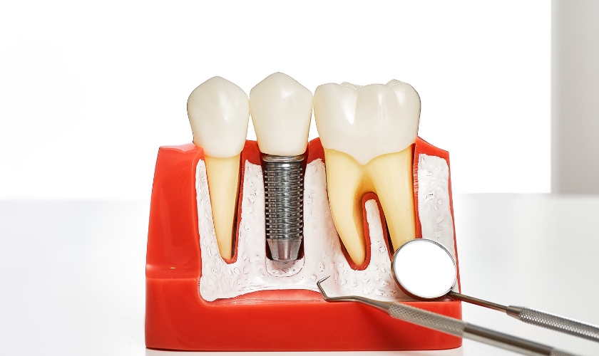 Warning Signs of Dental Implant Complications